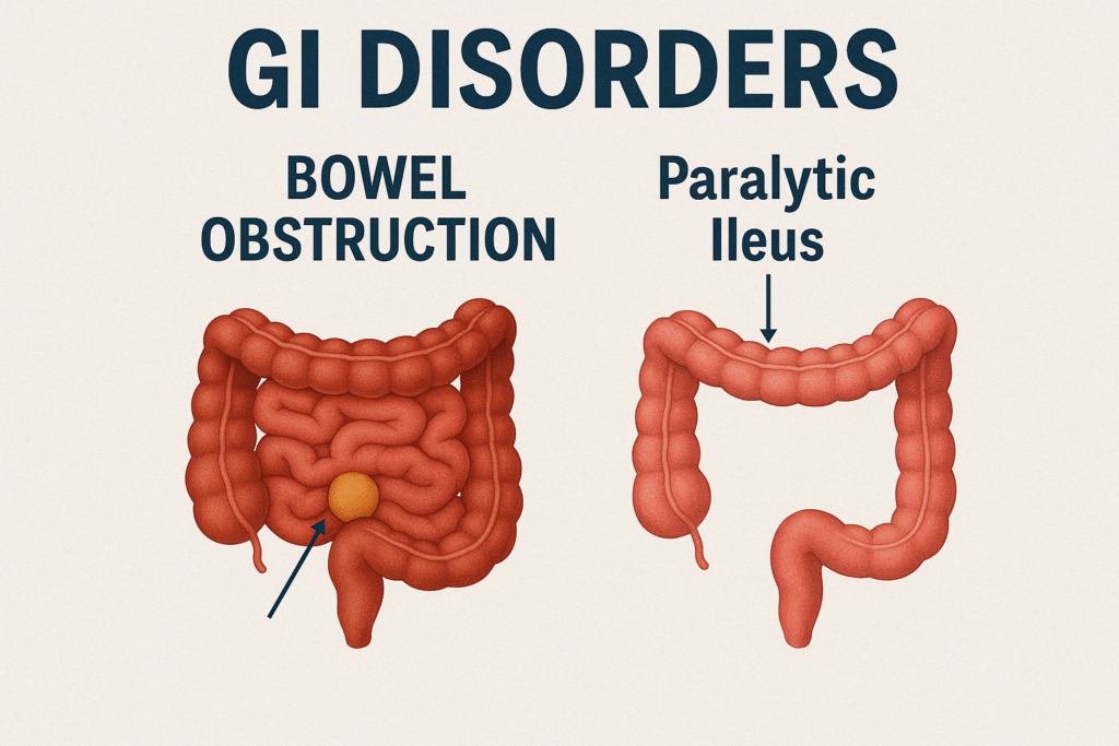 GI Disorders — Part 3 of 4: Bowel Obstruction & Paralytic Ileus ...